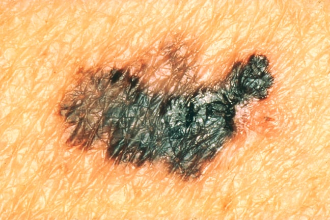 Signs & Symptoms of Melanoma | Willamette Valley Cancer Institute