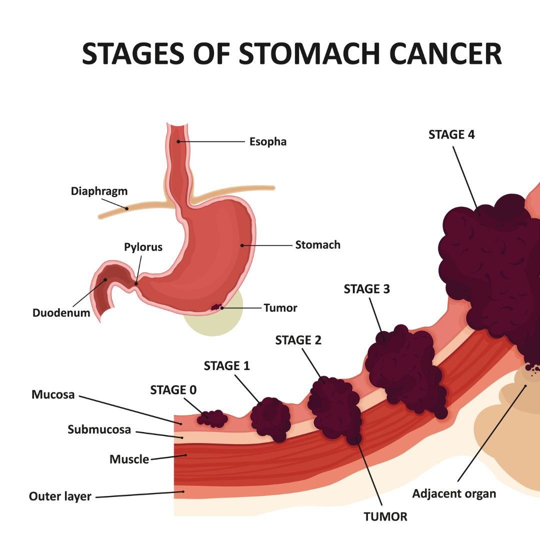 An Overview of Stomach Cancer | Oregon's GI Cancer Specialists